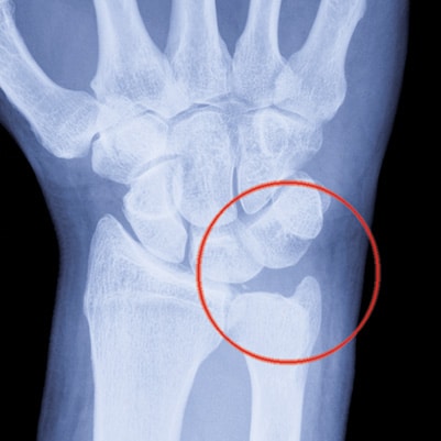 Che cos'è la TFCC - Mebocare: WristWidget TFCC strap & 3NS Tex tape